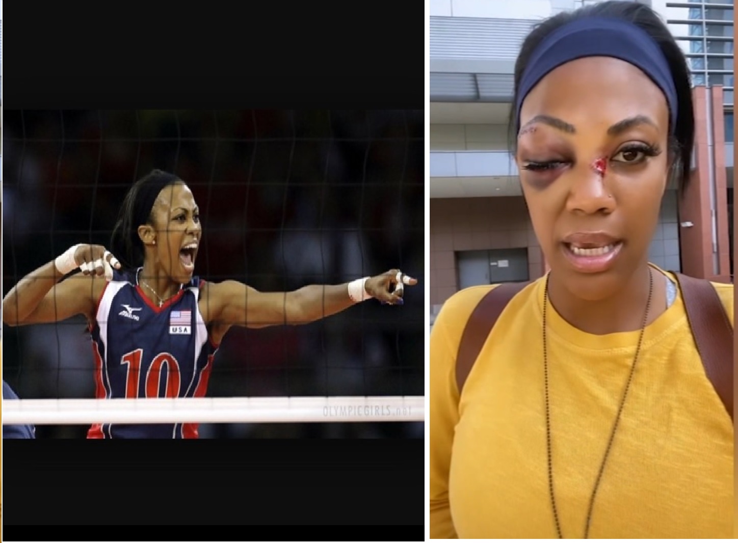 前奧運女排選手 遭遊民襲擊掛彩 | 星島日報